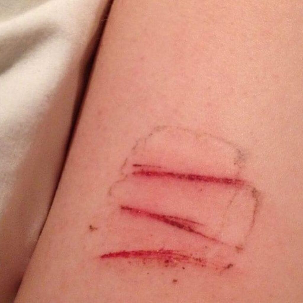 Why Do Adolescents Engage in Self-Harm or ‘Cutting’?